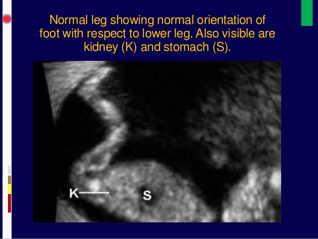 Isuog Practice Guidelines Performance Of First Trimester Fetal Ultras…