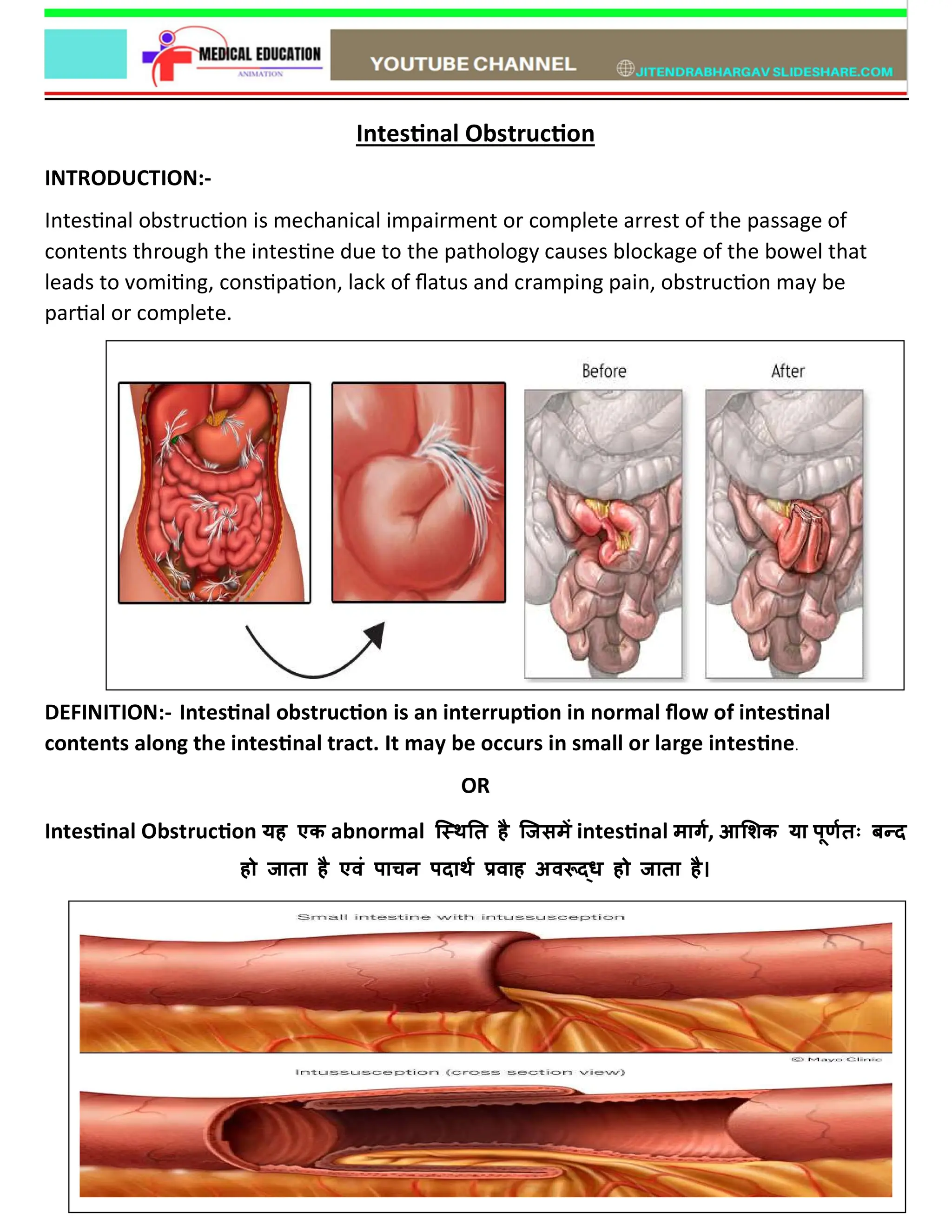 Intestinal obstruction in MEDICAL SURGICAL NURSING Jitendra bhargav ...