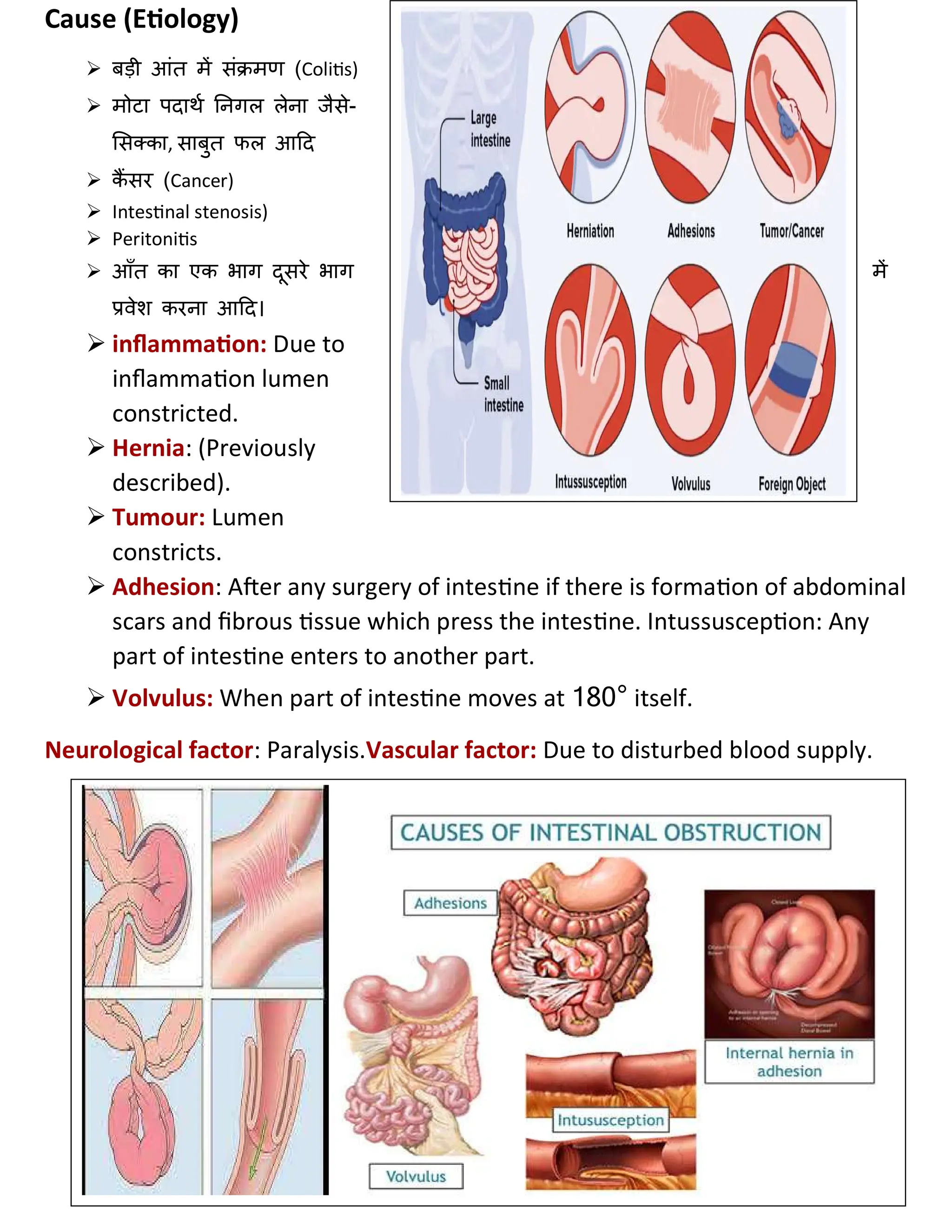 Intestinal obstruction in MEDICAL SURGICAL NURSING Jitendra bhargav ...