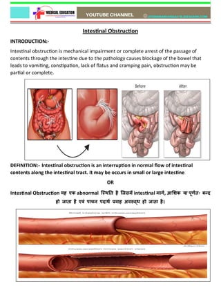 Intestinal obstruction in MEDICAL SURGICAL NURSING Jitendra bhargav ...