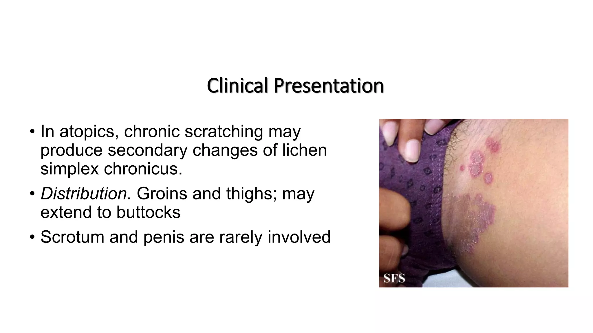 Itchy groins | PDF | Skin and Dermatology | Diseases and Conditions