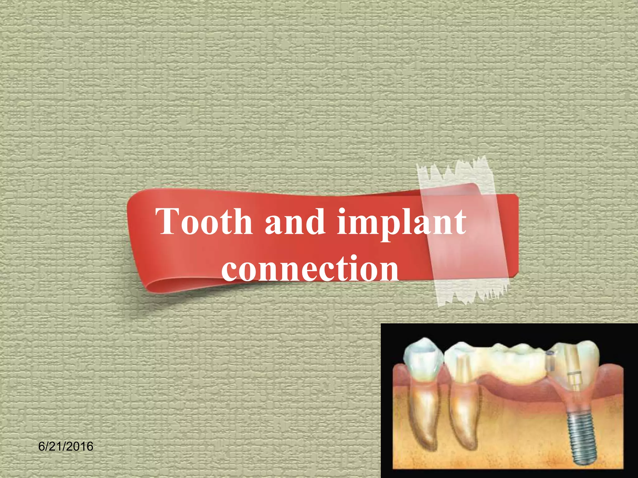 Implant tooth connection | PPT