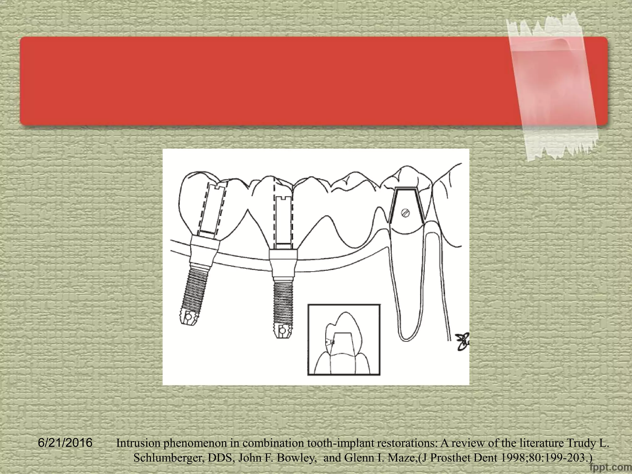 Implant tooth connection | PPTX | Dental Health | Diseases and Conditions