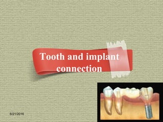 Implant tooth connection | PPTX | Dental Health | Diseases and Conditions