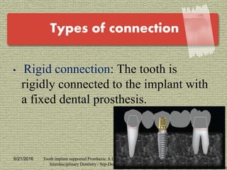 Implant tooth connection | PPTX