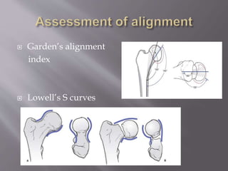 #It femur and #nof | PPT