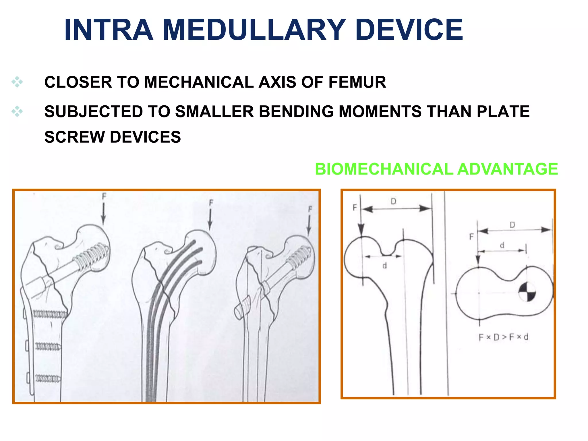 Fracture IT Femur | PPTX