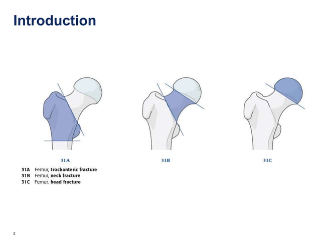 Fracture IT Femur | PPT