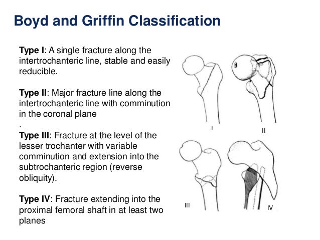 Fracture IT Femur