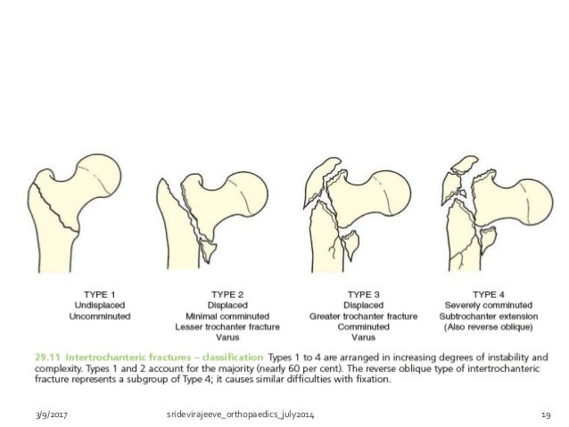 Intertrochentric femur fracture by DR.NAVEEN RATHOR