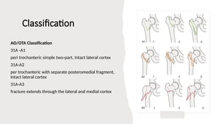IT fracture.pptx inter trochenteric fractures. | PPT