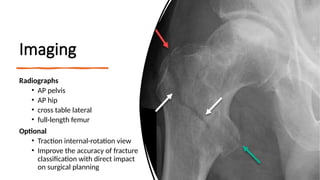 IT fracture.pptx inter trochenteric fractures. | PPTX