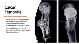 IT fracture.pptx inter trochenteric fractures. | PPT