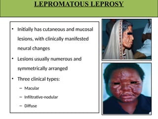 IT_Leprosy.sindhu final.pptx integrated teaching | PPT