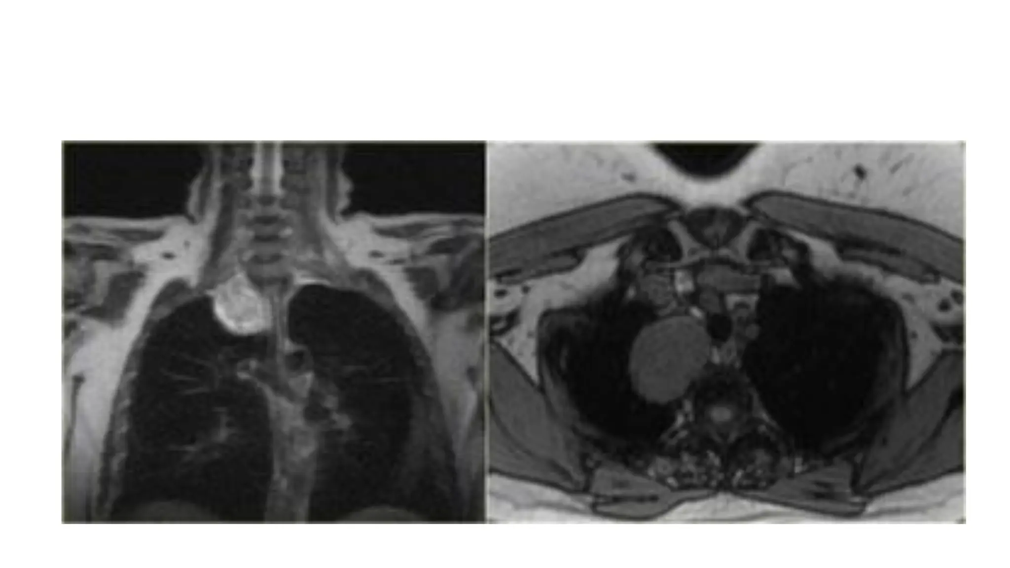 ITMIG classification posterior mediastinal masses.pdf
