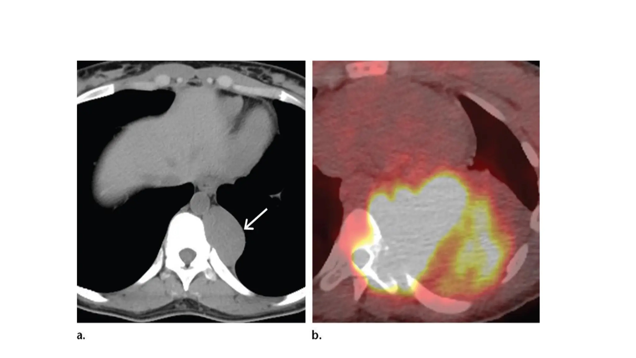 ITMIG classification posterior mediastinal masses.pdf