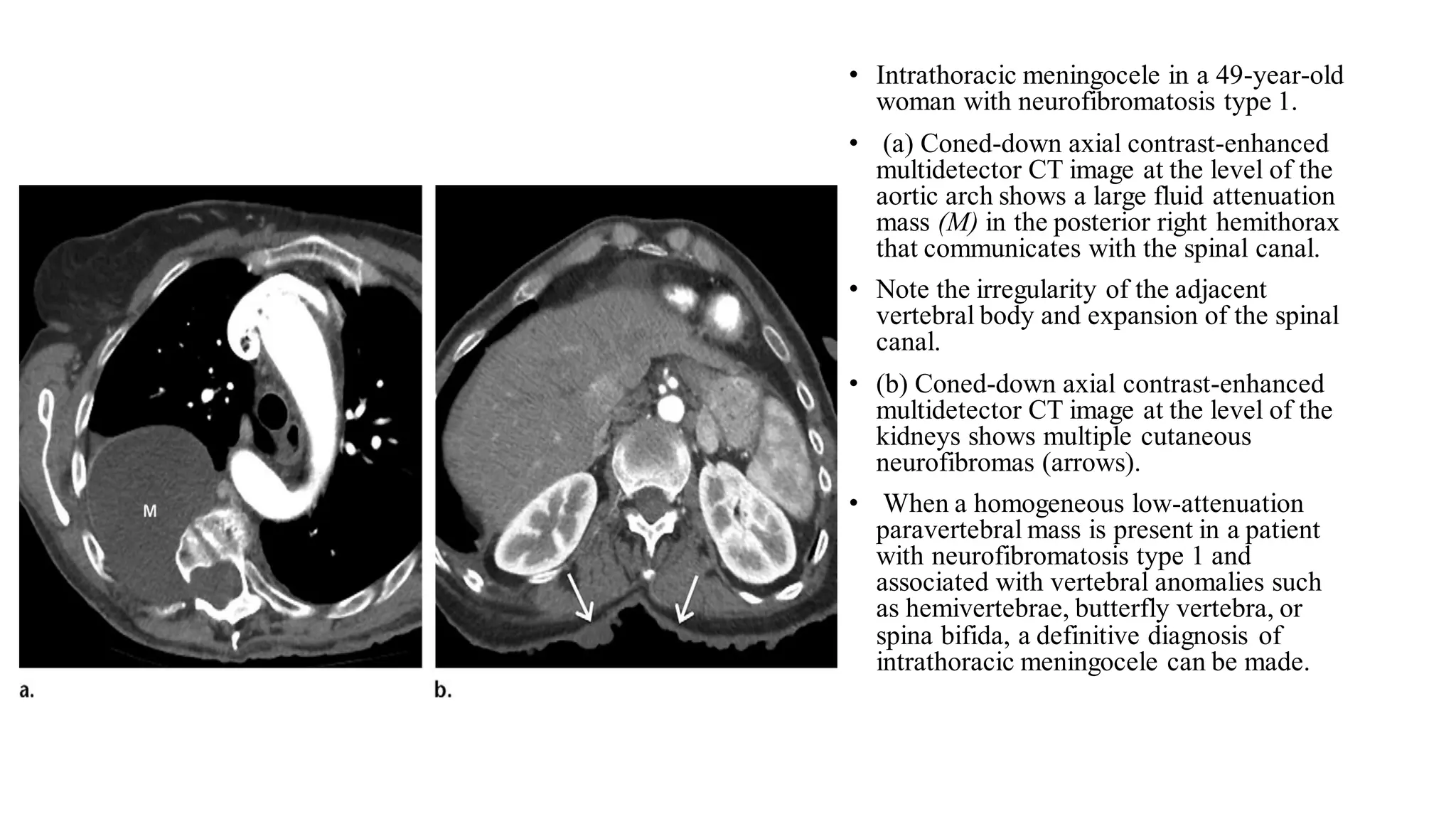 ITMIG classification posterior mediastinal masses.pdf