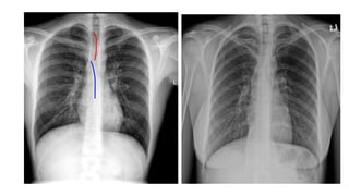 ITMIG classification posterior mediastinal masses.pdf