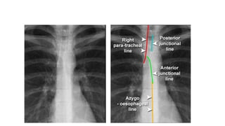 ITMIG classification posterior mediastinal masses.pdf