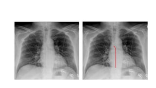 ITMIG classification posterior mediastinal masses.pdf