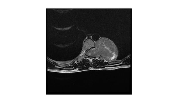 ITMIG classification posterior mediastinal masses.pdf