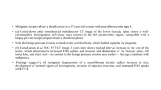 ITMIG classification posterior mediastinal masses.pdf