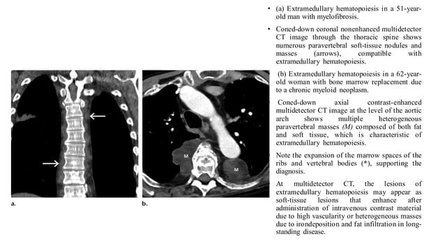 ITMIG classification posterior mediastinal masses.pdf
