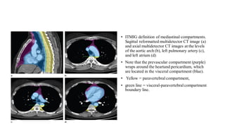 ITMIG classification posterior mediastinal masses.pdf