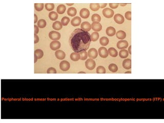 Idiopathic thrombocytopenia purpura | PPT
