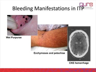 Immune thrombocyopenia (ITP) | PPTX
