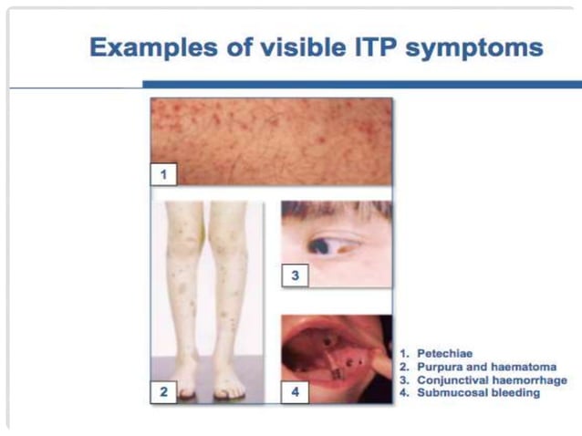 ITP - How to Approach | PPT | Blood Disorders | Diseases and Conditions