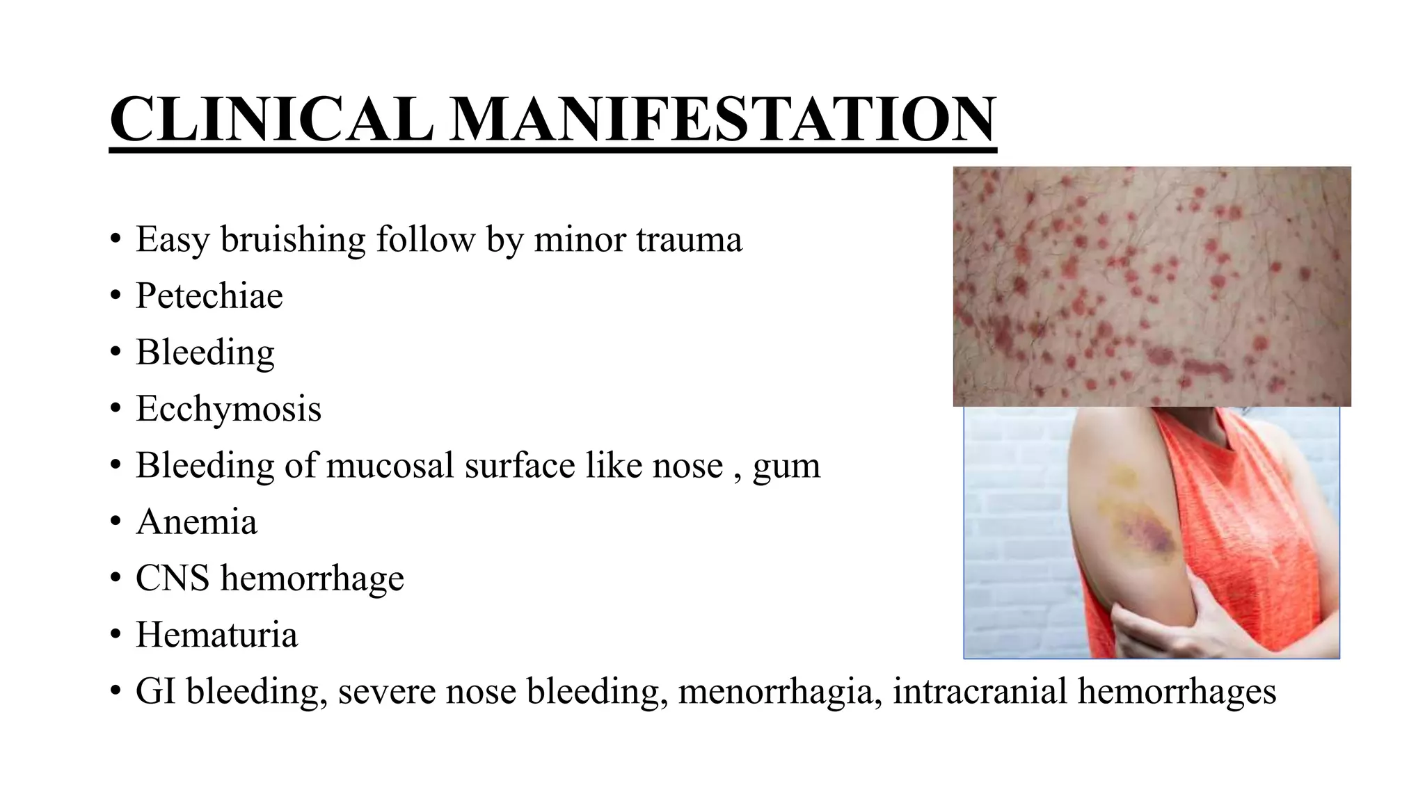 Idiopathic thrombocytopenic pupura (ITP) | PPT