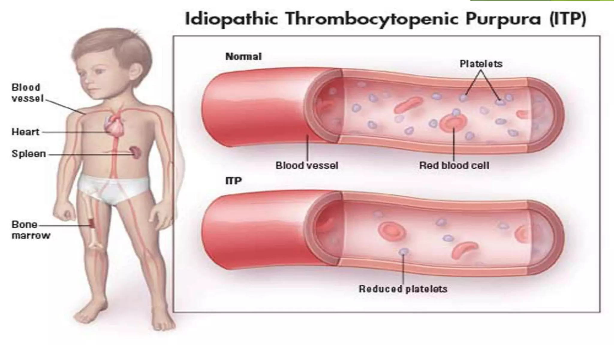 IDIOPATHIC THROMBOCYTOPENIC PURPURA (ITP) | PPTX