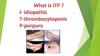 IDIOPATHIC THROMBOCYTOPENIC PURPURA (ITP) | PPT