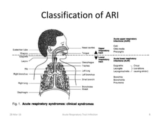 Acute respiratory tract infection | PPTX