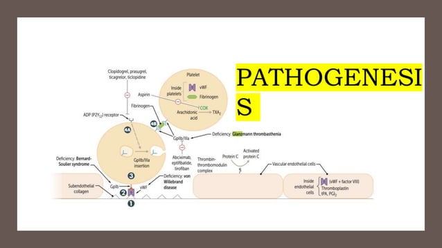 ITP (Immune Thrombocytopenia) | PPTX