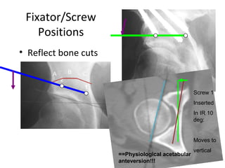 Interlocking Triple Pelvic Osteotomy - John O'Hara | PPT