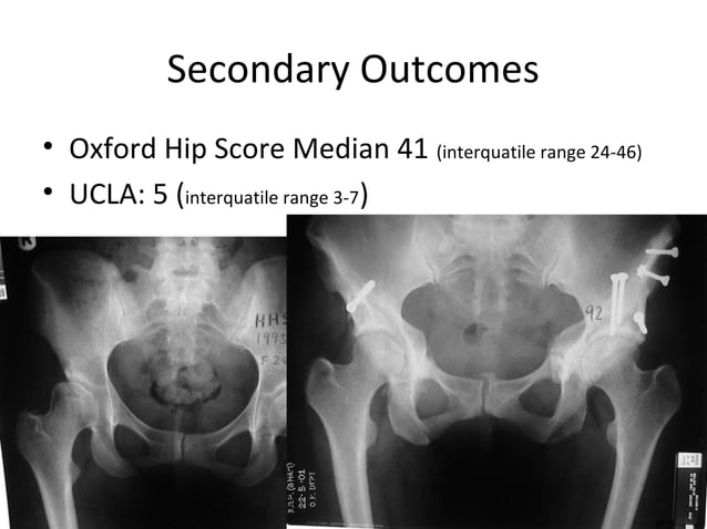 Interlocking Triple Pelvic Osteotomy - John O'Hara | PPT