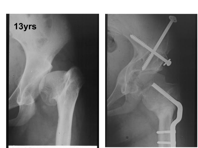 Interlocking Triple Pelvic Osteotomy - John O'Hara | PPT
