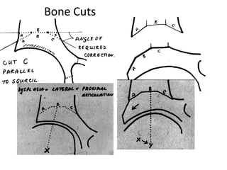 Interlocking Triple Pelvic Osteotomy - John O'Hara | PPT