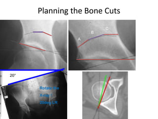 Interlocking Triple Pelvic Osteotomy - John O'Hara | PPT
