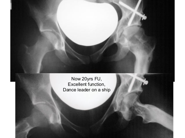 Interlocking Triple Pelvic Osteotomy - John O'Hara