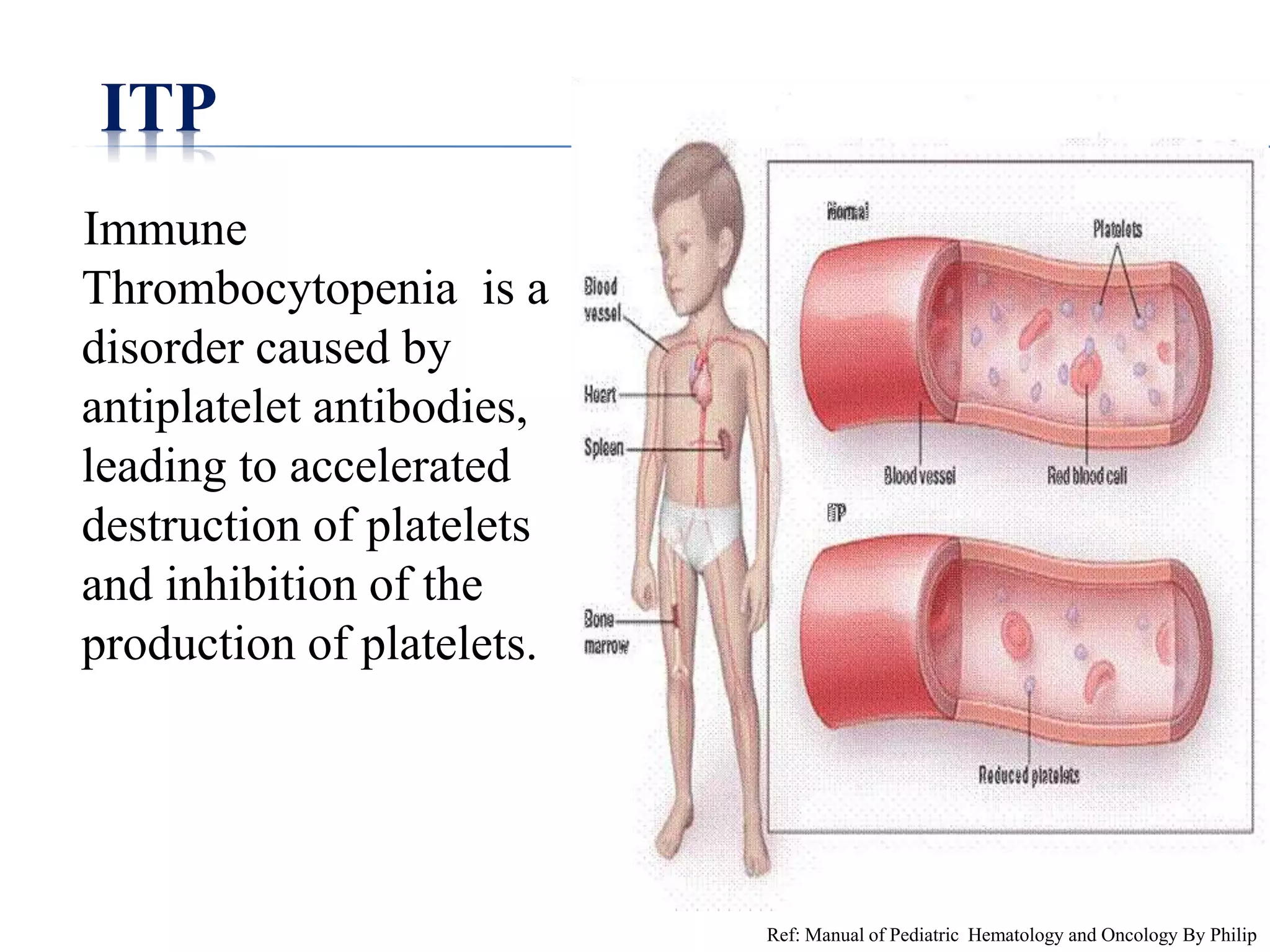 Immune Thrombocytopenia (ITP) | PPTX