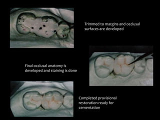 Interim and Temporary restorations | PPTX