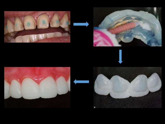 Interim and Temporary restorations | PPTX