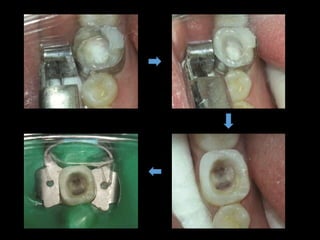 Interim and Temporary restorations | PPTX