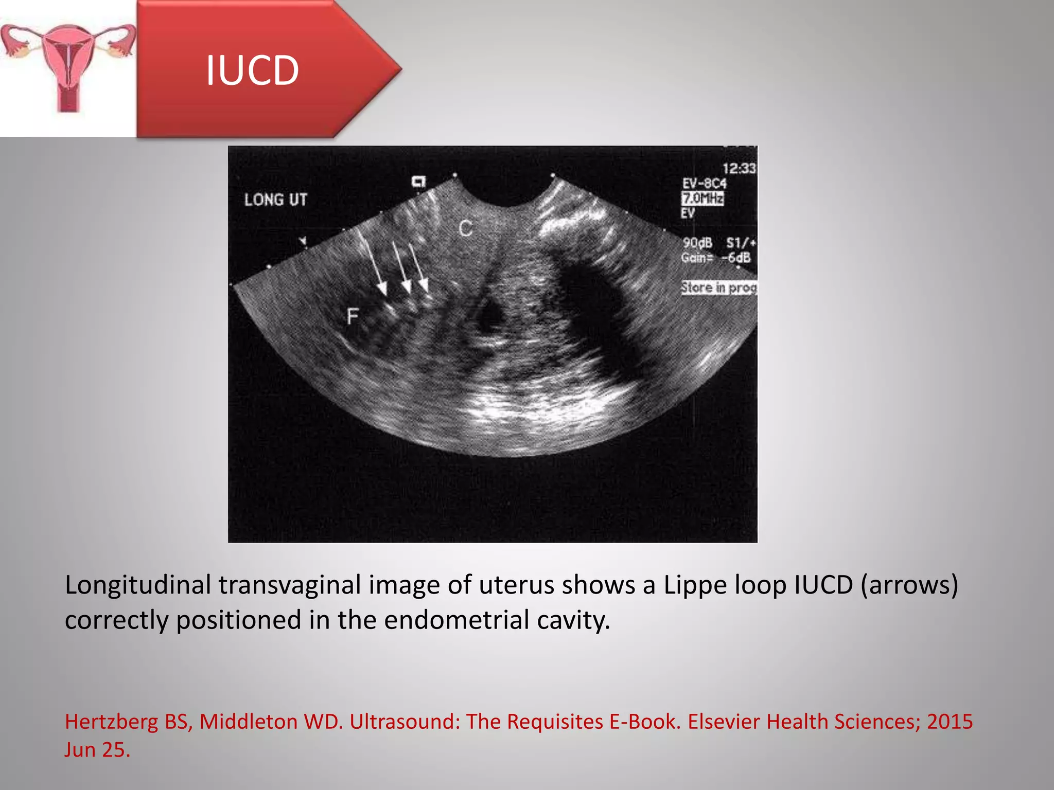 Role of Ultrasound in the assessment of Intrauterine Contraceptive ...