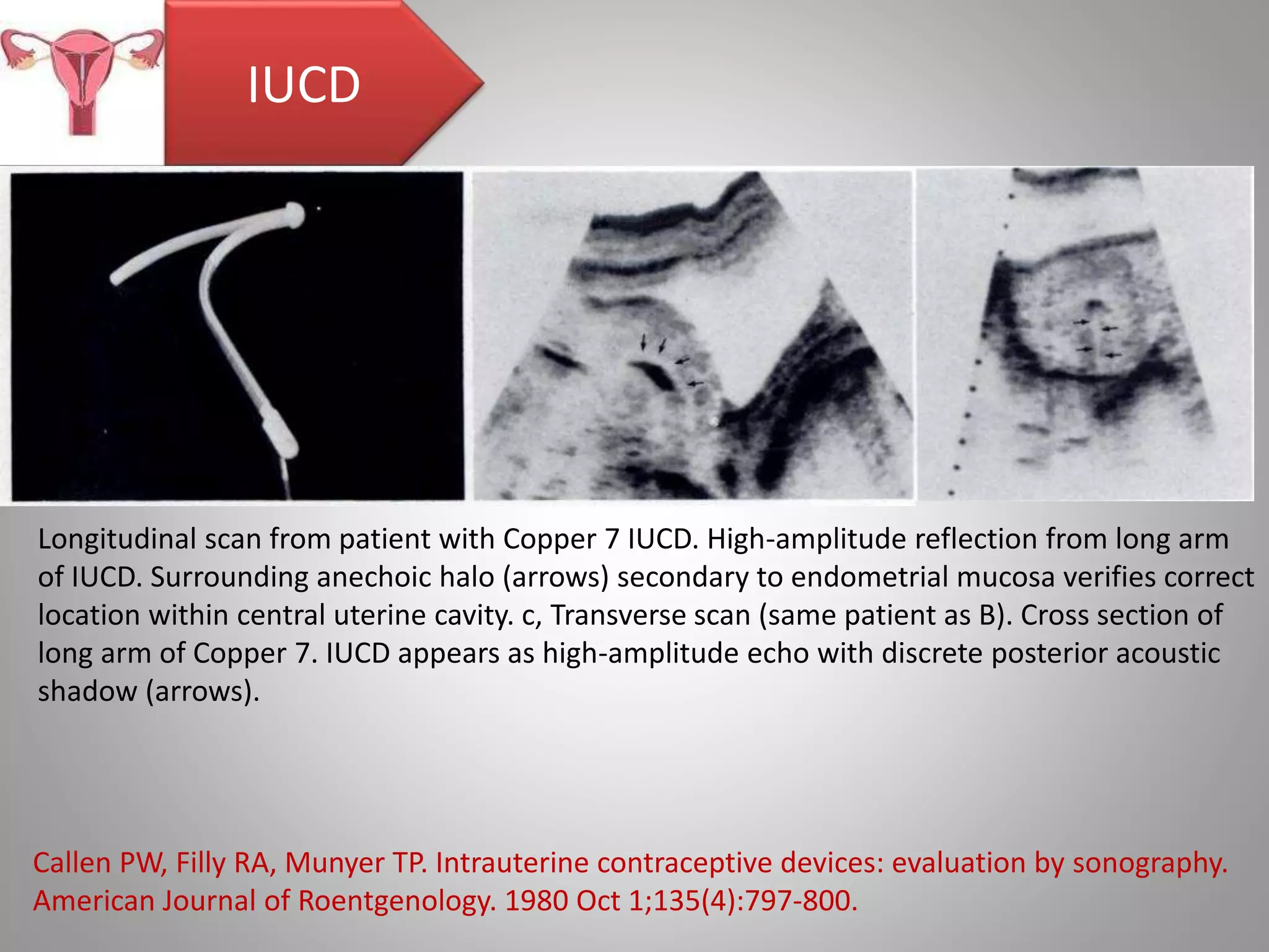 Role of Ultrasound in the assessment of Intrauterine Contraceptive ...