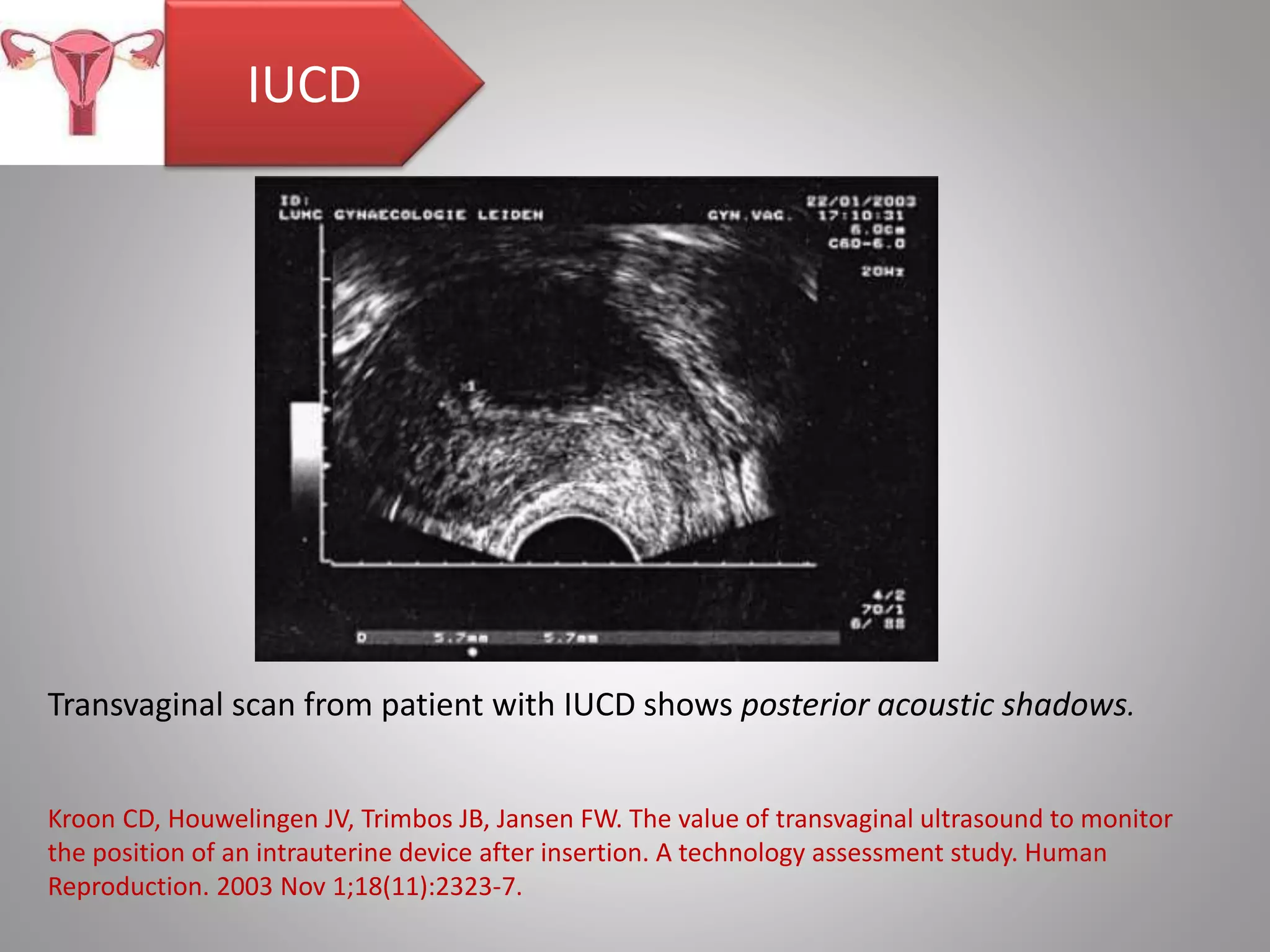 Role of Ultrasound in the assessment of Intrauterine Contraceptive ...