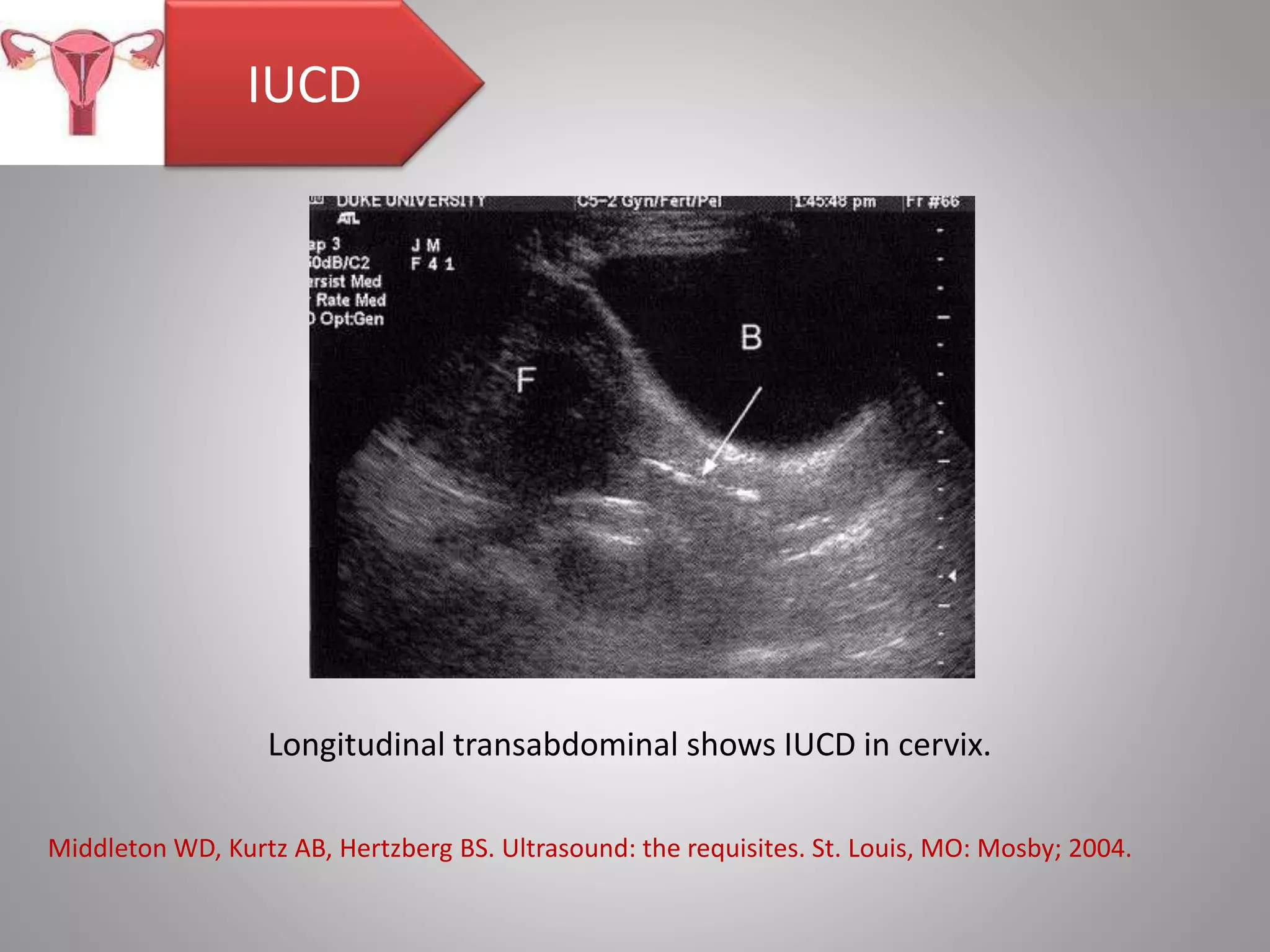 Role of Ultrasound in the assessment of Intrauterine Contraceptive ...